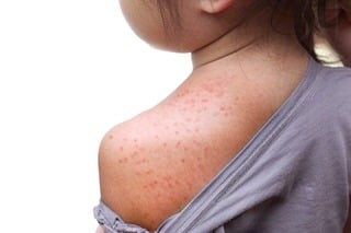Amoxicillin Rash: Signs & Treatment for Amoxicillin Rash